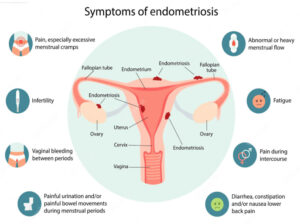 Rectovaginal Endometriosis | Dr Aaron Ndhluni | Specialist Surgeon